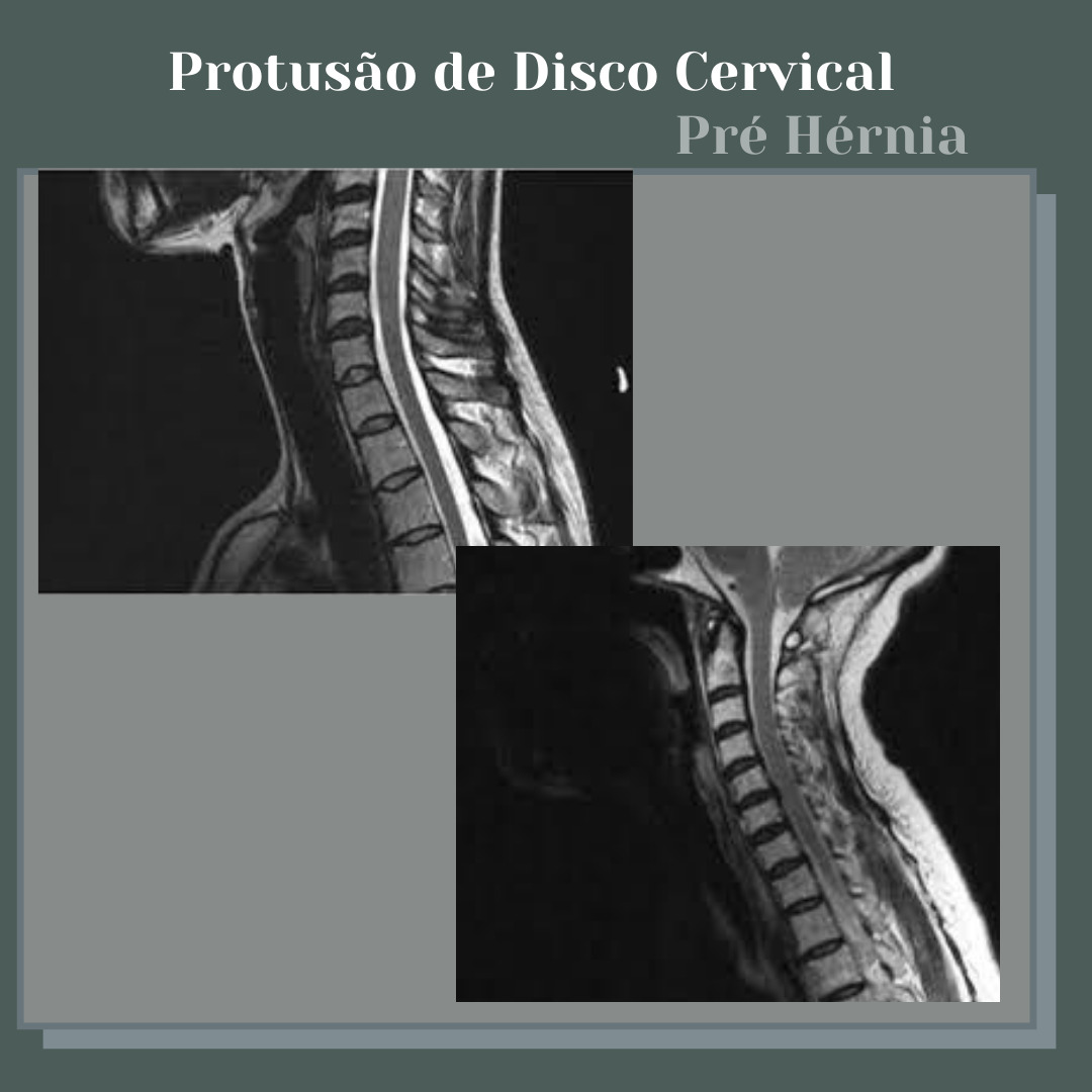 Protusão de Disco Cervical - A Pré Hérnia! :: Anatomia das Lesões